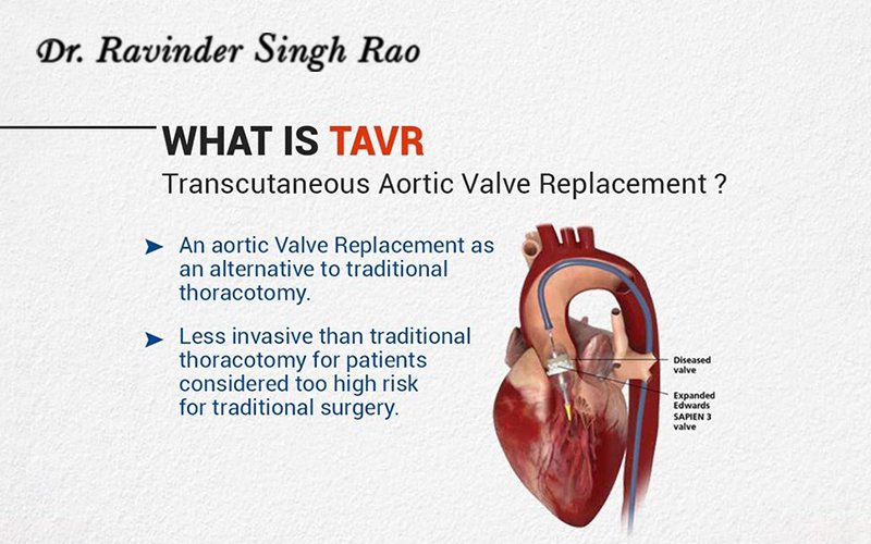 TAVR: Transcatheter Aortic Valve Replacement without Open Heart Surgery TAVR: Transcatheter Aortic Valve Replacement without Open Heart Surgery